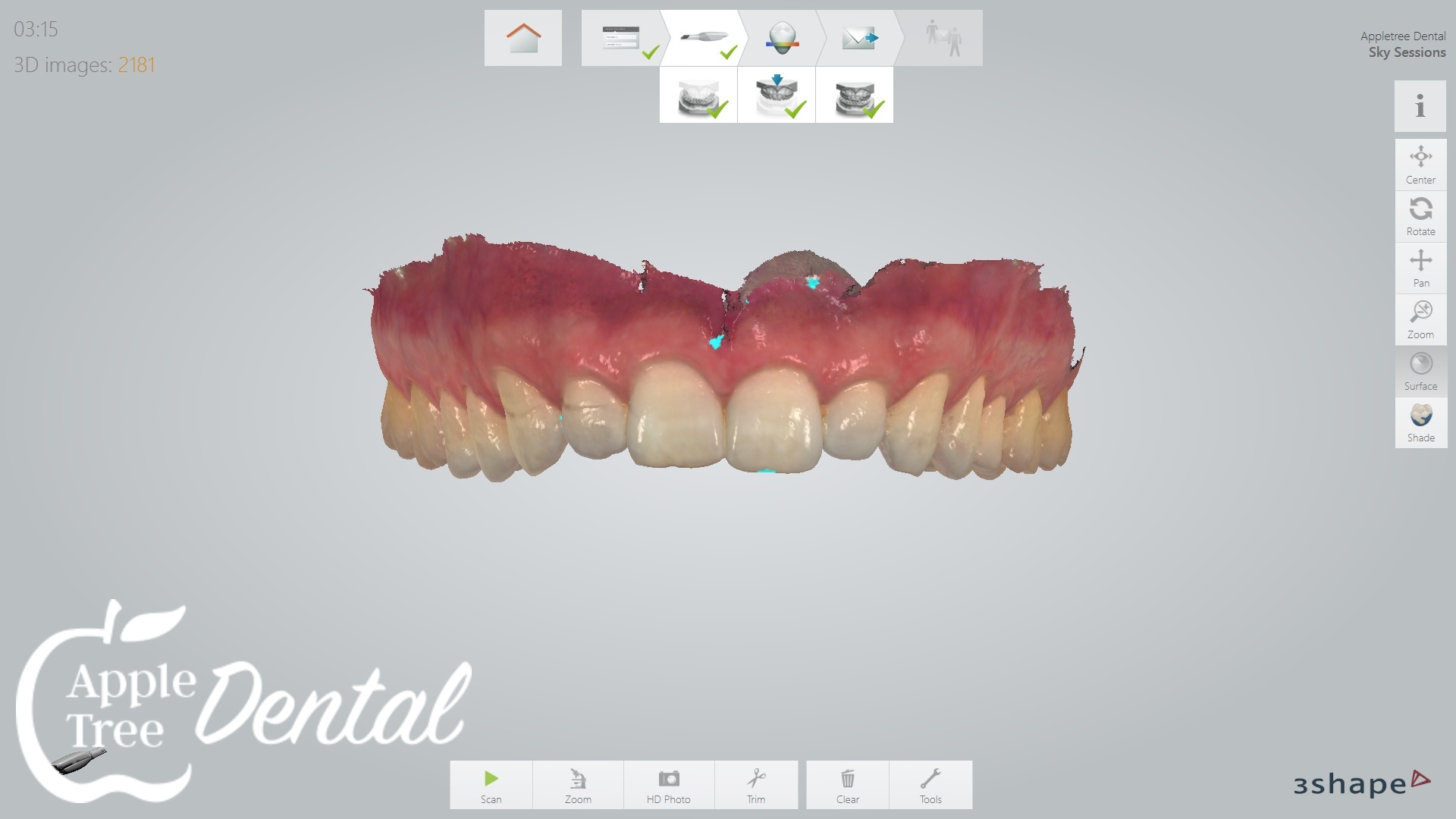 No Messy Dental Impressions Blog